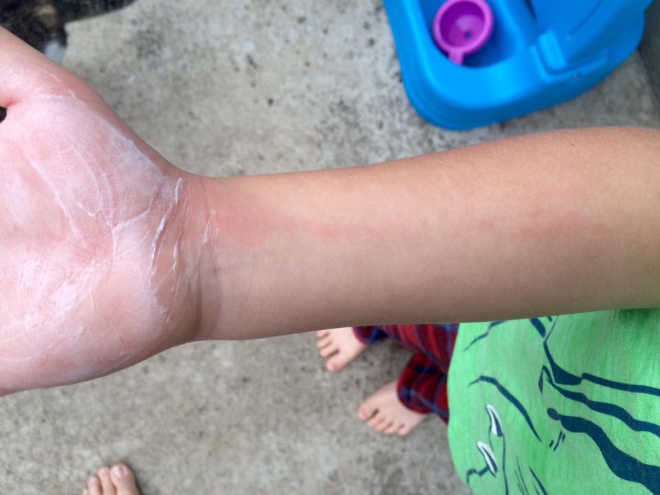 Wasp Sting Swollen Toe